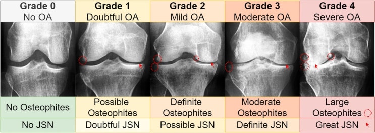 K-L grade vs ICRS grade vs OB grade : 네이버 블로그