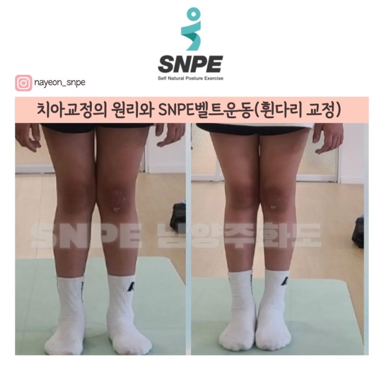 SNPE운동 휜다리교정 도움될까? : 네이버 블로그