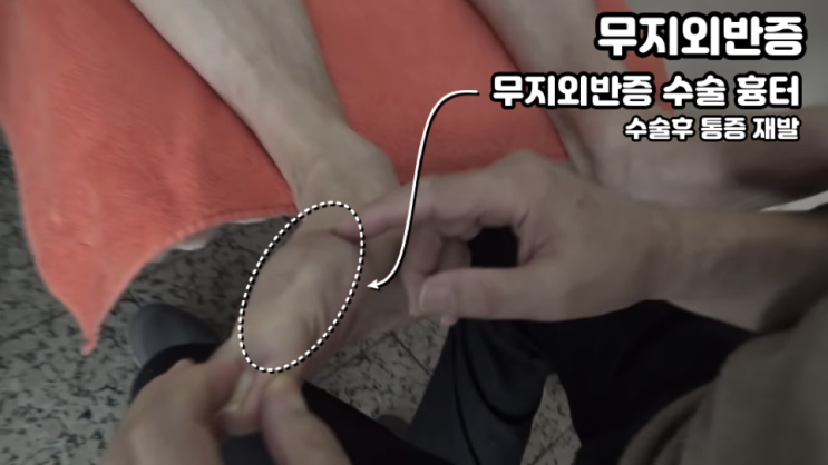 265. 수술 후 6년간 계속되는 무지외반증 15분 KSNS 스본 스도로 80% 개선 : 네이버 블로그