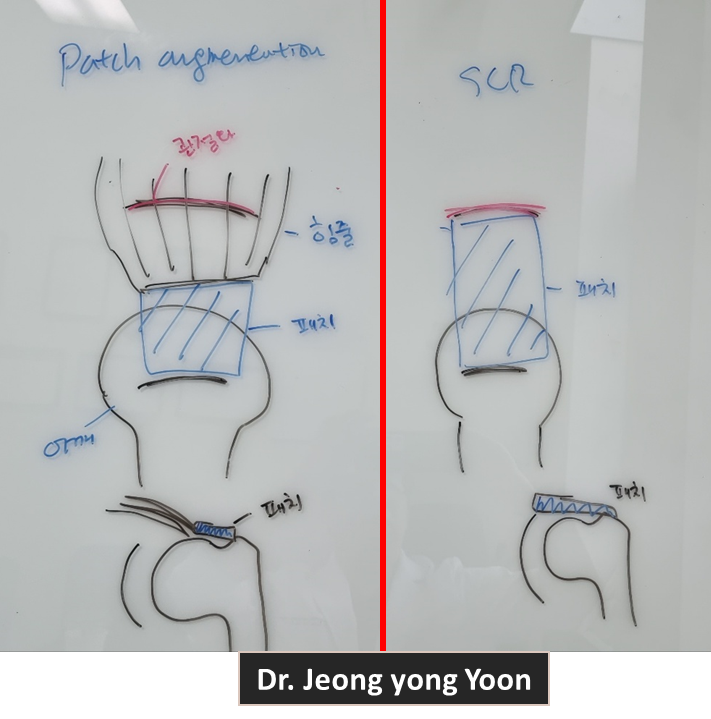 광범위 회전근개 파열. 패치 수술에 대하여. (SCR or Patch augmentation) : 네이버 블로그