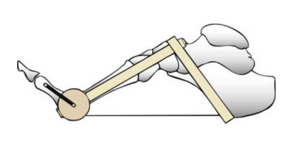윈들러스 메커니즘 l WINDLASS MECHANISM [1] : 네이버 블로그