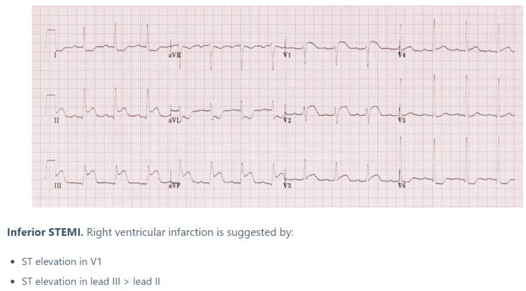 STEMI, RV infarction (우심실 STEMI, 우심실 경색), V4R 심전도 : 네이버 블로그