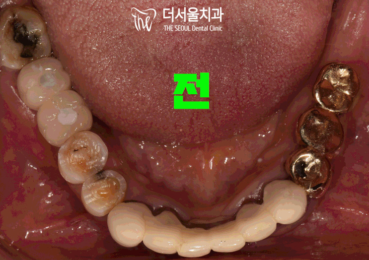 더서울치과 오래된 브릿지 통증으로 아랫니 임플란트 받으셨던 분 즉시 식립 2탄 네이버 블로그