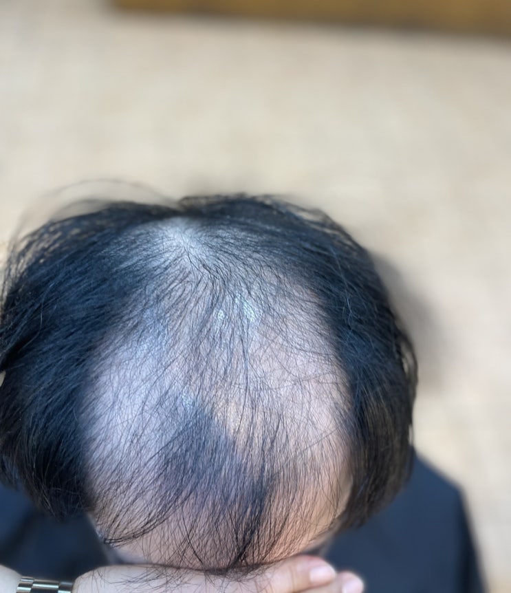 경상남도김해에서 왔어요 이마정수리 탈모심함 남자탈모성형펌 부산사상르네시떼미용실부산미용사상미용감전미용괘법미용덕천미용화명미용서면
