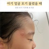 아기 얼굴 모기 물렸을 때 물집 알레르기 스터키증후군 대처법 네이버 블로그