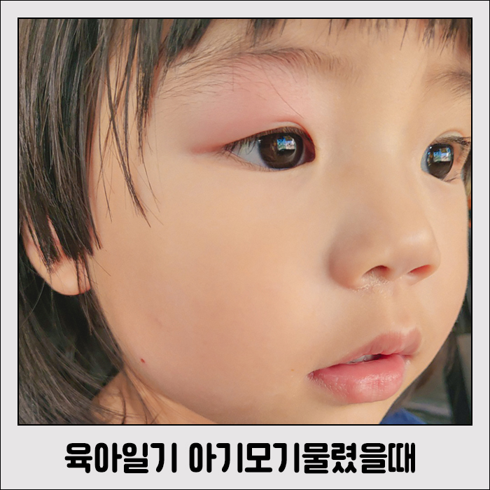 육아일기 아기모기물렸을때 아기모기약 없이 보내기 네이버 블로그