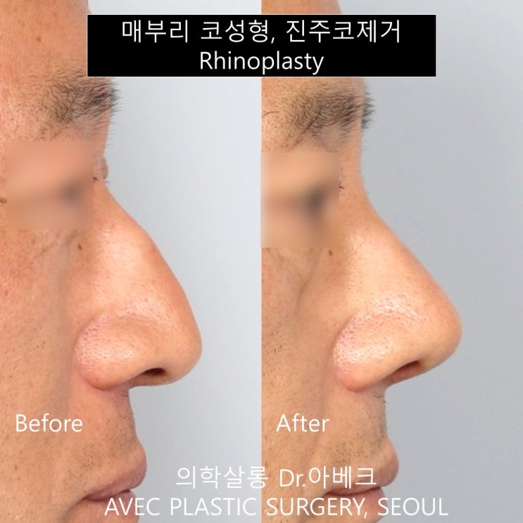 매부리코휜코 코수술 후기 진주코 제거 【dr 아베크 코성형】 네이버 블로그
