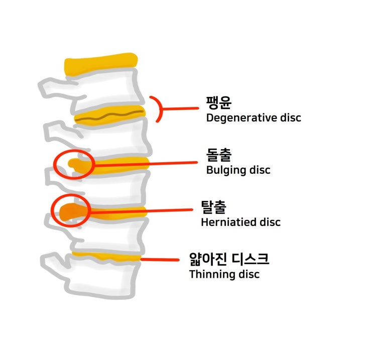 NS-spine ) 경추 전방 디스크 제거수술 ACDF (anterior cervical discectomy & fusion ...