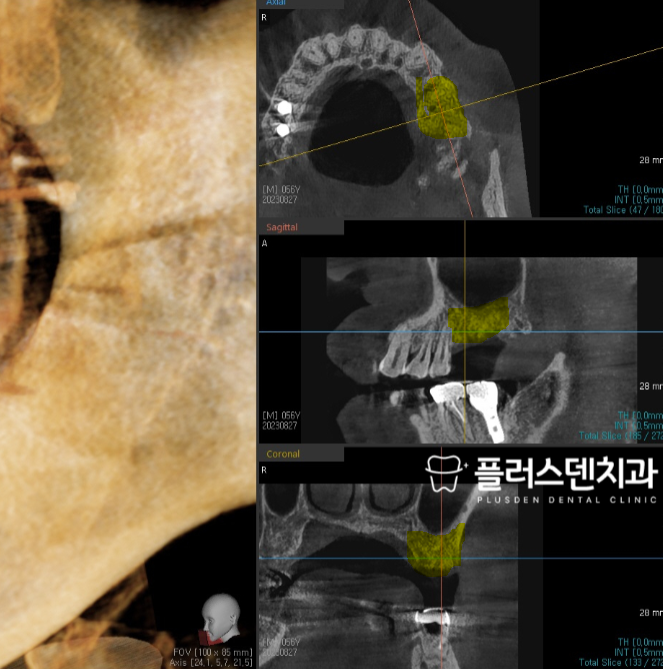 심한 염증 치아를 플러스덴 치과 에서 상악동 거상술 뼈이식과 전농동 임플란트 로 회복하기 네이버 블로그