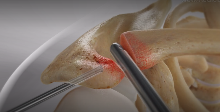 Shoulder-A/S distal clavicle resection : 네이버 블로그