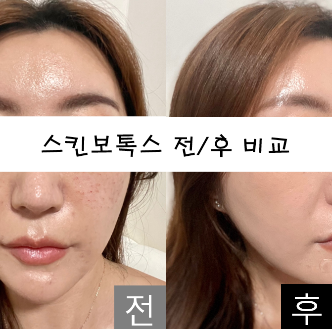 내돈내산 첫 강남역 스킨보톡스 후기 효과 주기 가격 부작용 통증 멍 엠보 네이버 블로그