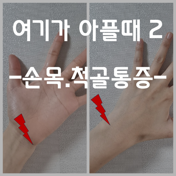 재활의학과 새끼손가락 쪽 손목통증 척골충돌증후군 삼각섬유연골복합체 통증 1 증상과 원인 네이버 블로그