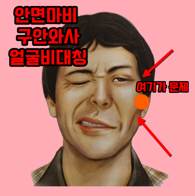 안면마비 골든타임 구안와사 도침치료 매선요법으로 정상으로 빠르게 회복 수원영통한의원 네이버 블로그