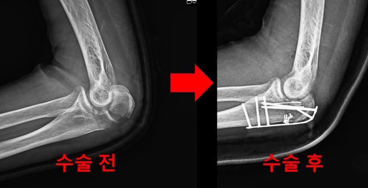 고령 파킨슨 기저질환 환자에서의 복잡 주두골절 Comminuted Olecranon Fracture 케이스의 성공적인 수술