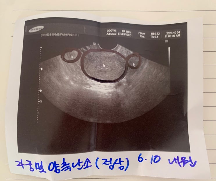 고사난자 계류유산 소파술 2주차까지 후기 및 증상 임테기는 여전히 두줄 네이버 블로그