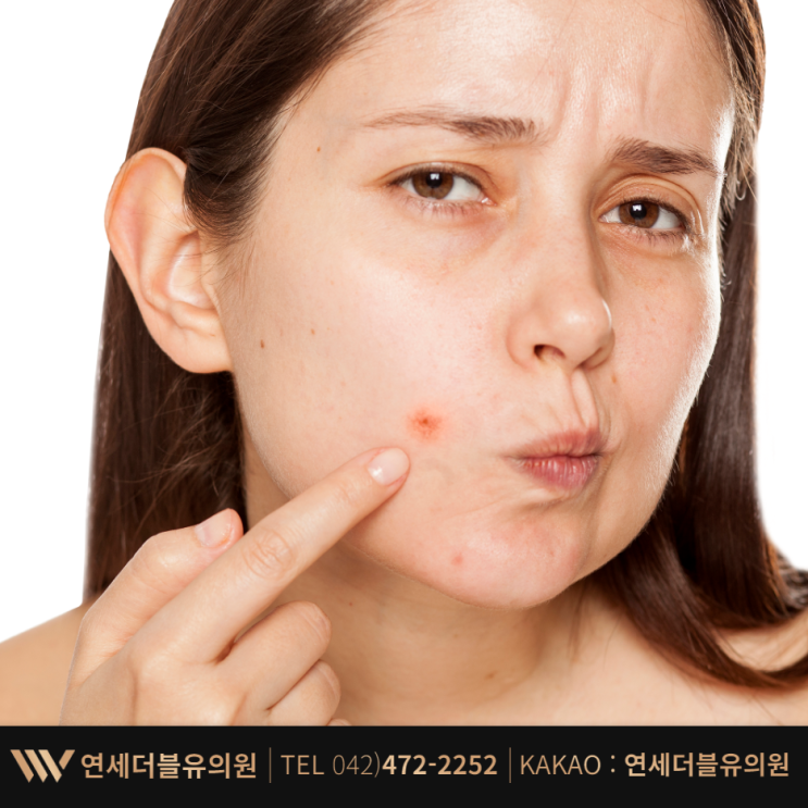 짤 수 없는 여드름 관리 방법은 네이버 블로그