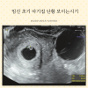 임신초기 임신5주 아기집 난황보이는시기 임신6주 난황위치성별 각도법 네이버 블로그