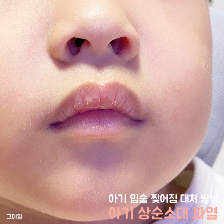 아기 입술 찢어짐 아기 상순소대 찢어짐 파열 대처 방법 그리고 이 년 후 네이버 블로그