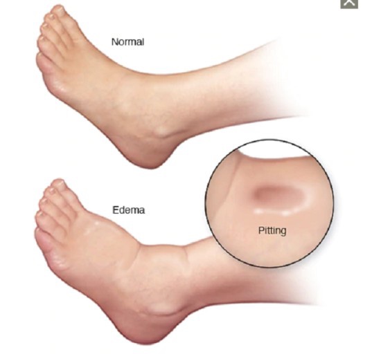 [IM RN] Pitting edema : 네이버 블로그