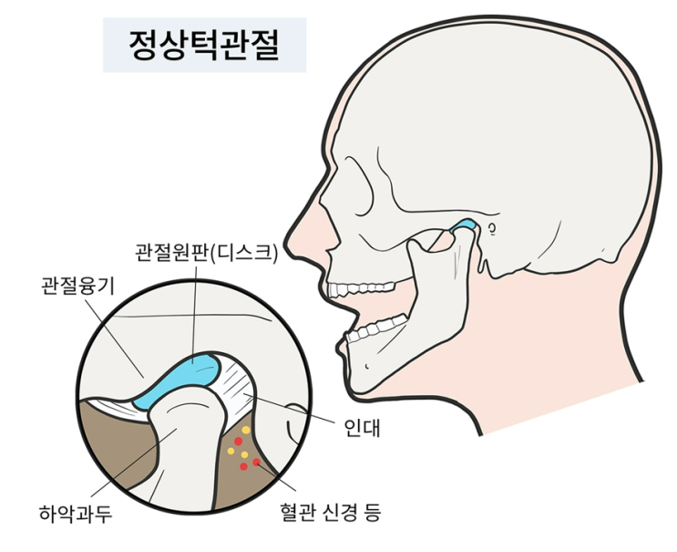 귀밑 턱 통증과 턱관절 소리 원인 및 증상 신방화역한의원 네이버 블로그
