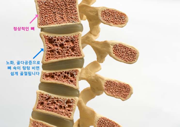 경피적 척추성형술 받기 전 필독 주의사항 원리 총정리 네이버 블로그