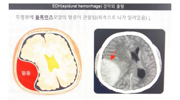 의학용어 EDH, SDH, SAH, ICH, IVH 증상, 치료, 간호! : 네이버 블로그