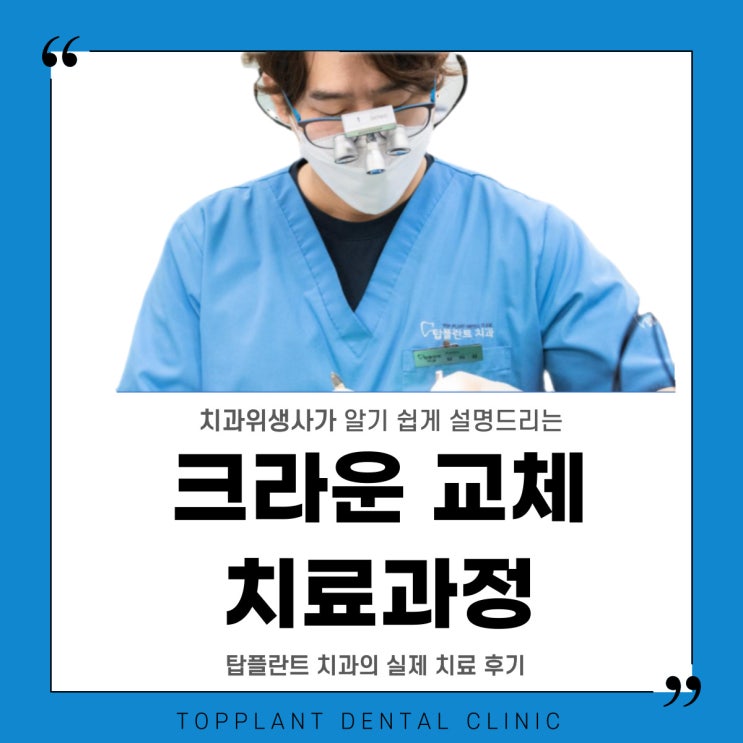 크라운 하방 2차 충치 치료 구멍 난 금니 교체하기 성남 태평역 탑플란트치과 실제 치료 후 네이버 블로그