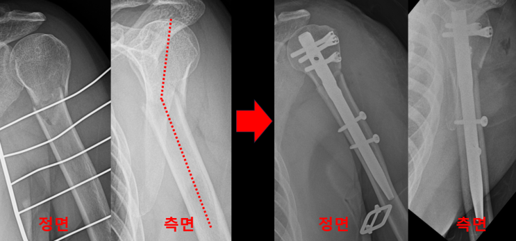 근위 상완골 골절 Proximal Humerus Fracture 무조건 금속판으로 수술해야 할까요 금속정으로 수술 시에 더
