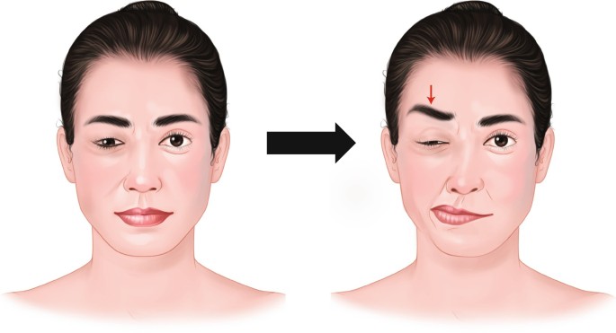 Facial Spasm(안면 연축) : 네이버 블로그
