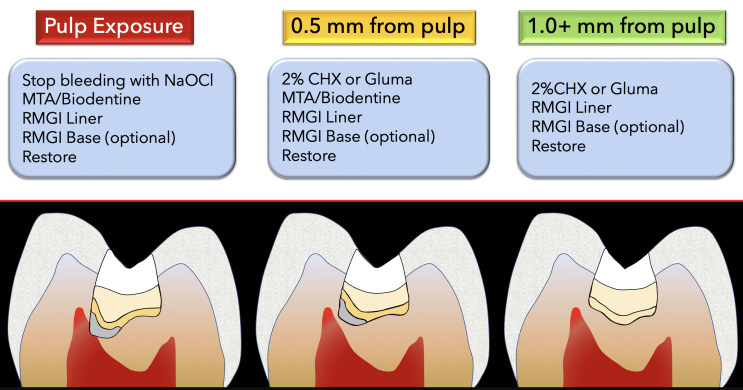 [엔도] 치수복조술(Pulp Capping)에 관한 생각 (Feat. 치수노출, MTA) : 네이버 블로그