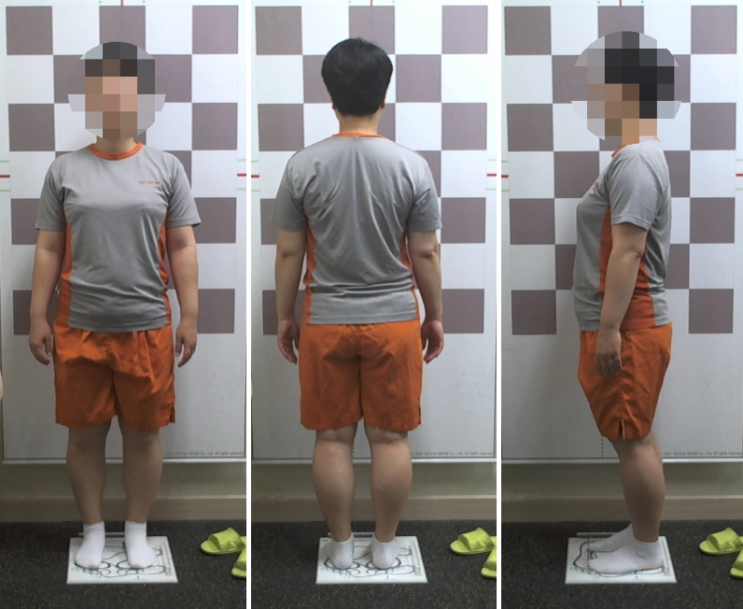 안산필라테스 척추측만증 수술이후 운동 네이버 블로그