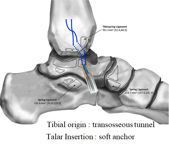 Ankle-Deltoid ligament rupture - Open deep and superificial deltoid ...