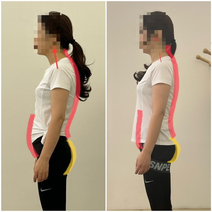 울산 굽은등 어깨 체형교정 치료 후기 보여드릴게요체형교정센터 부작용 네이버 블로그
