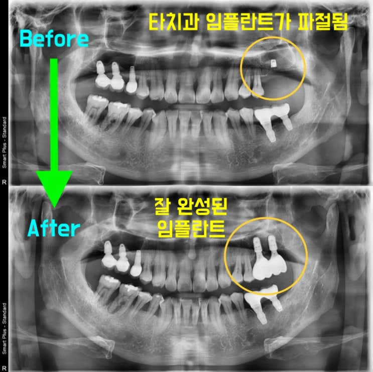 광명치과 임플란트 재수술 상악동 거상술을 해야한다면 잘하는 곳에서 네이버 블로그