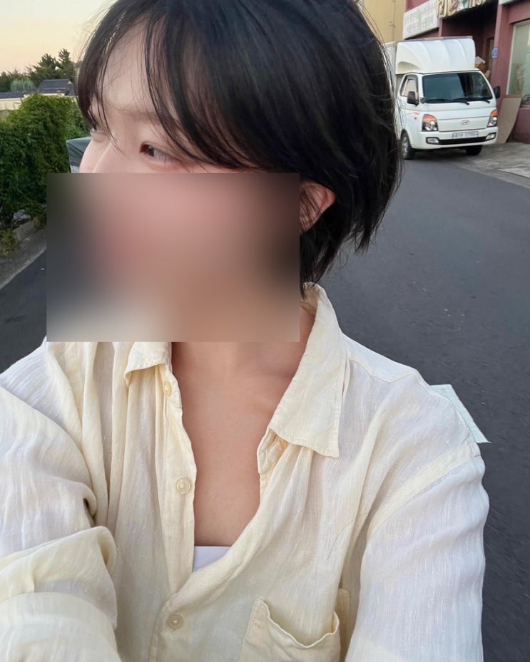 무쌍 쌍수 한 달차 / 비절개 쌍수 후기 : 네이버 블로그