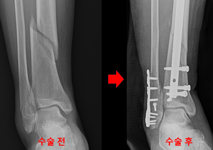 고령의 원위 경비골골절 Distal Tibio Fibular Fracture에서 경골과 비골에 금속정과 금속판을 각각 이용한