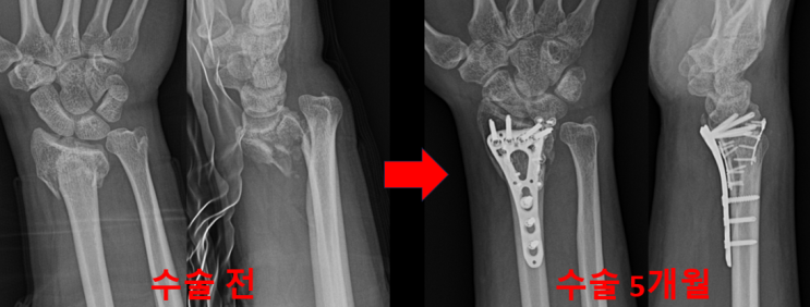 젊은 환자에서의 심한 손목 골절 Distal Radius Fracture 콜레스골절 수술 후기 손목 외고정 Vs 내고정