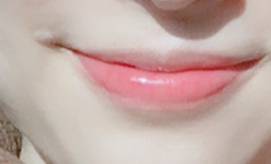 오래된! 입가 점뺀흉터 제거수술 후기(찐내돈) : 네이버 블로그