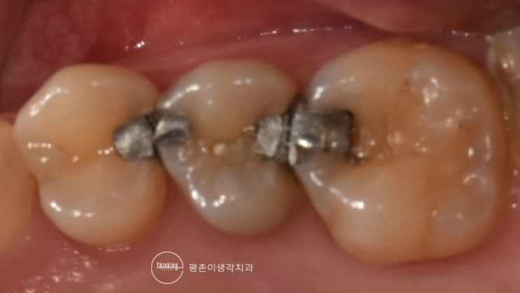 오래된 아말감 레진 수복물 제거 후 깨끗한 치아 얻어가신 범계 치과 20대 여성분 네이버 블로그