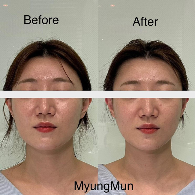 얼굴균형맞추기 통증 없이 건식으로 비대칭 중점관리 : 네이버 블로그