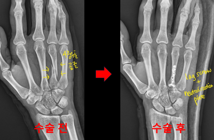 운동선수의 제4 중수골 골절 Metacarpal Shaft Fracture 금속판으로 수술 후 빠른 재활 한 달째 손