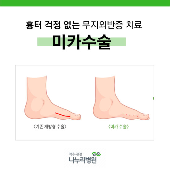 수원관절병원 무지외반증 통증 잡는 미카수술 네이버 블로그