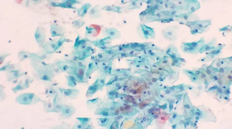 조직병리학 오답 정리 : 네이버 블로그