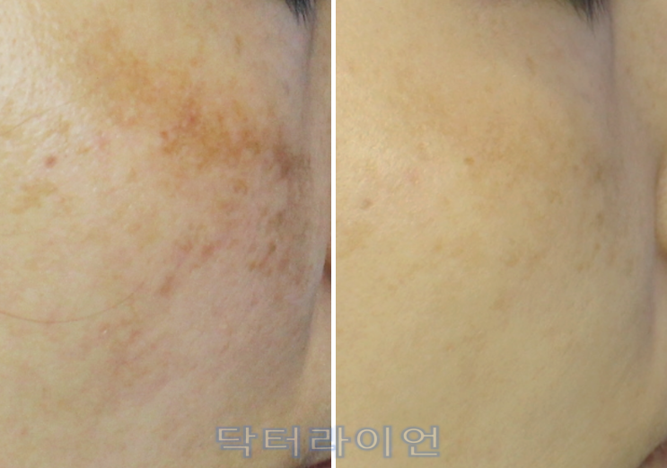 기미 피코토닝 비교분석피코슈어피코하이피코웨이가장 좋은 피코레이저는 네이버 블로그