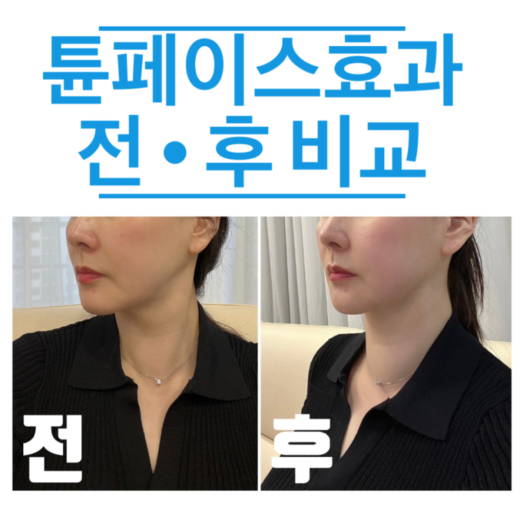 얼굴주름리프팅 튠페이스 효과 전•후 비교 강남역 피부과 관리후기 네이버 블로그