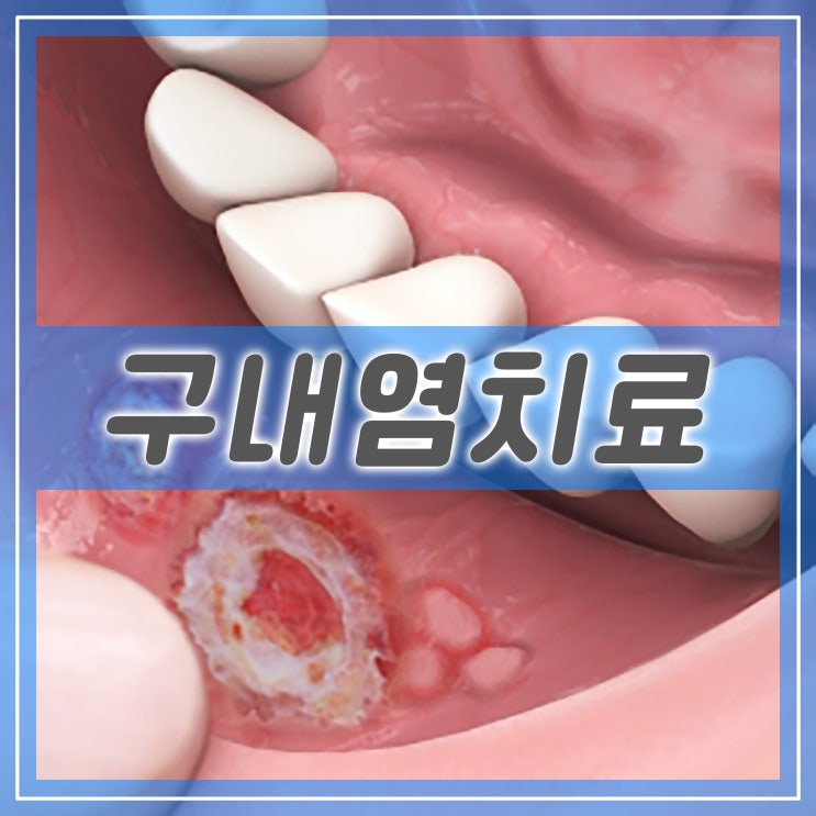 아프타성 구내염 원인 증상 전염성 치료법 빨리낫는법 목 편도 혓바닥 구내염 네이버 블로그