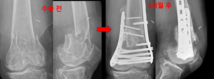 대퇴골 원위부 골절 Distal Femur Fracture 실패하기 쉬운 골절에서 불유합 발생을 줄이기 위한 수술 방법