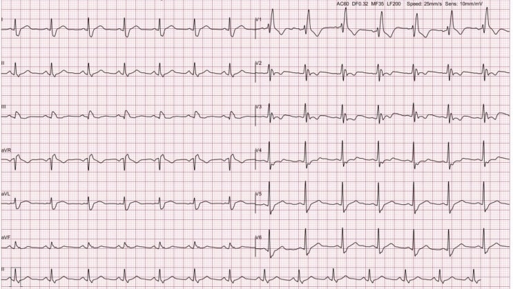 우각차단 (RBBB) 과 좌각차단 (LBBB) 심전도 : 네이버 블로그