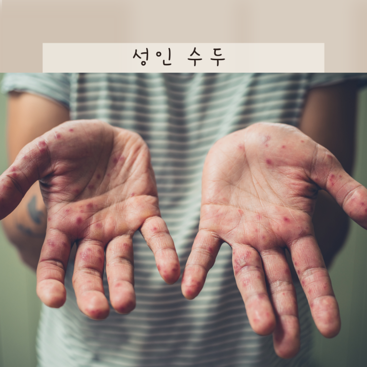 성인 수두 초기 증상 전염 격리 예방접종 1차 2차 필요한 이유 네이버 블로그