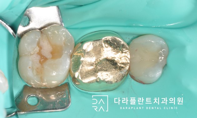탈락한 금인레이를 레진빌드업으로 치료한 케이스 일산 레진빌드업치과 네이버 블로그